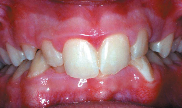 Common Problems - Haug Orthodontics | Alton, IL | Highland, IL