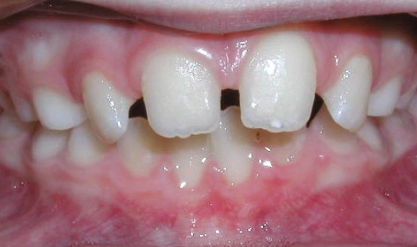 Common Problems - Haug Orthodontics | Alton, IL | Highland, IL
